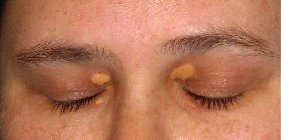 ADVANCED SKIN BLEMISH REMOVAL – Katie Lewis Hair Removal Clinic